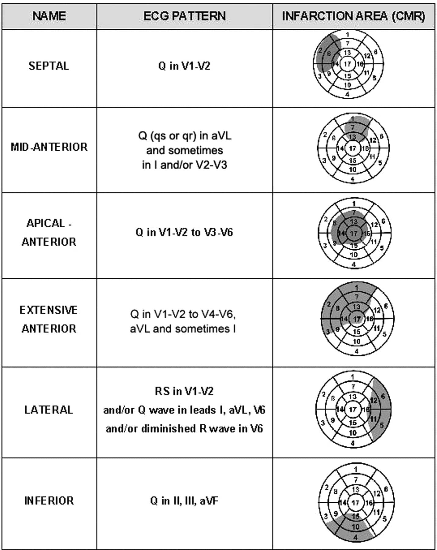 EKG: Infarktlokalisation - Kardiologi.se