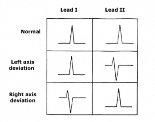 EKG: Bestäm Elaxel - Kardiologi.se