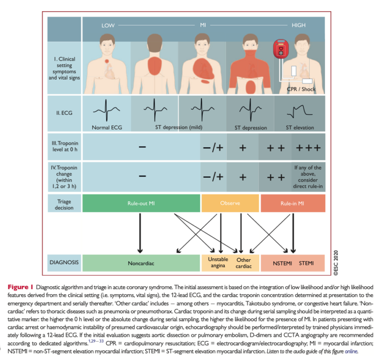 Definition Akut Koronart Syndrom (AKS) - Kardiologi.se