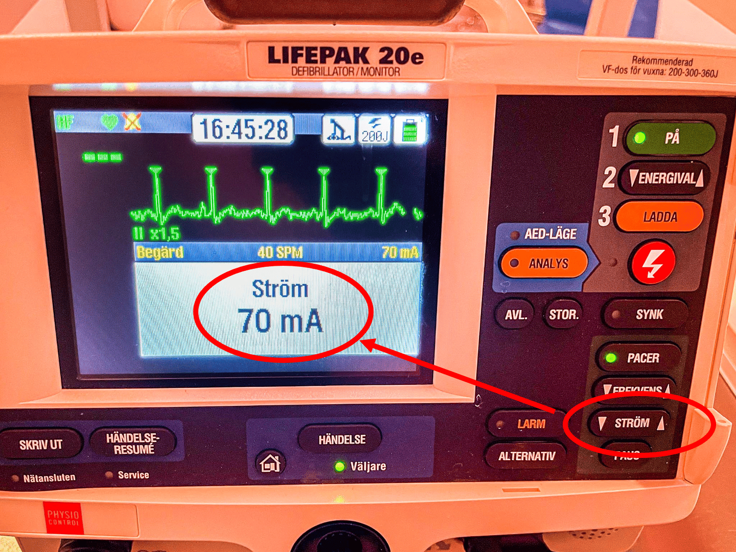Temporär Pacemaker (transkutan, transvenös) - Kardiologi.se