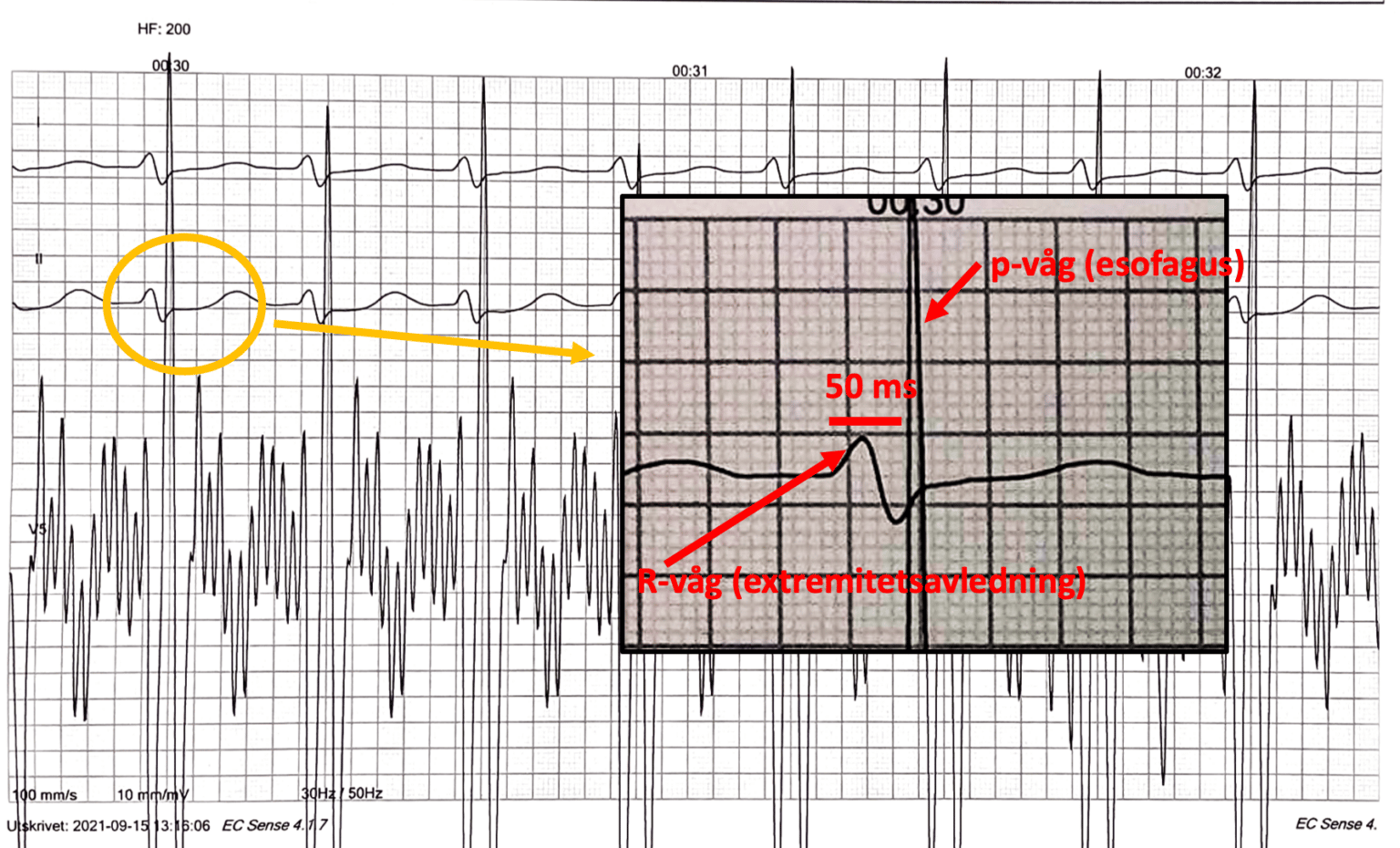 Esofagus-EKG: Genomförande och tolkning - Kardiologi.se