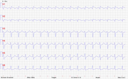 Esofagus-EKG: Genomförande och tolkning - Kardiologi.se