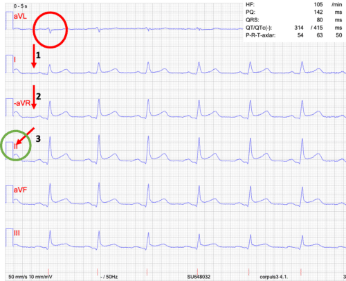 EKG: Bestäm Elaxel - Kardiologi.se