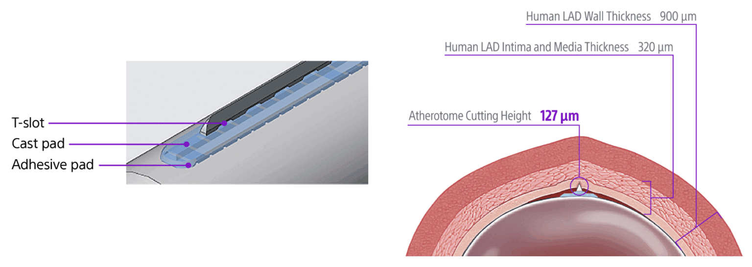PCI-behandling av förkalkade kranskärl: teknik, tips och evidens ...